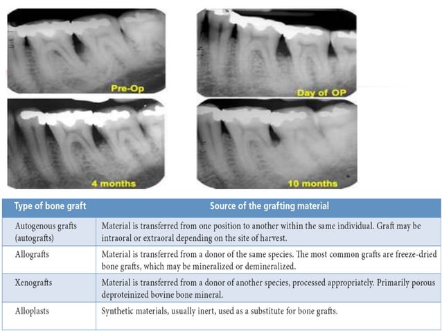 alveolar ridge expansion and socket preservation | PPT | Bone and Joint ...