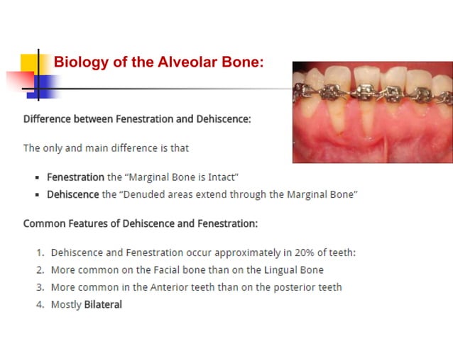 alveolar ridge expansion and socket preservation | PPT | Bone and Joint ...