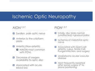 Ischemic Optic Neuropathy: A Sequala of Spinal Surgery | PPT