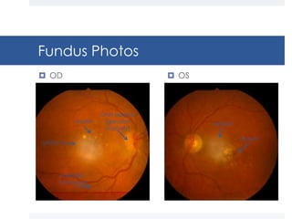 Ischemic Optic Neuropathy: A Sequala of Spinal Surgery | PPT