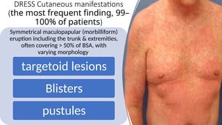Case presentation, DRESS syndrome in a rheumatoid arthritis patient ...