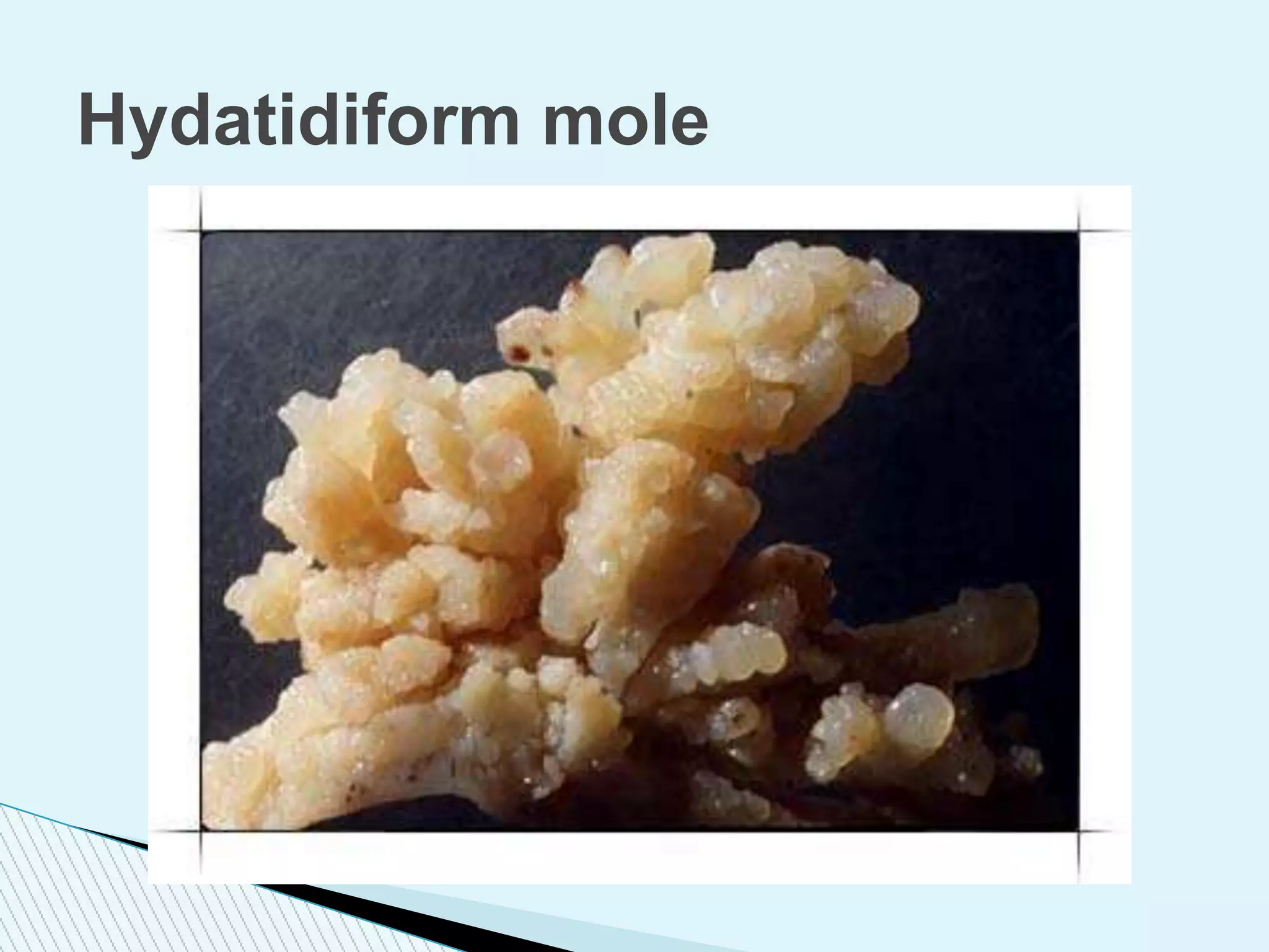 Hydatedform mole.pptx