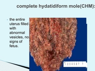 Hydatedform mole.pptx