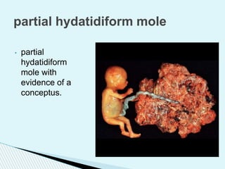 Hydatedform mole.pptx