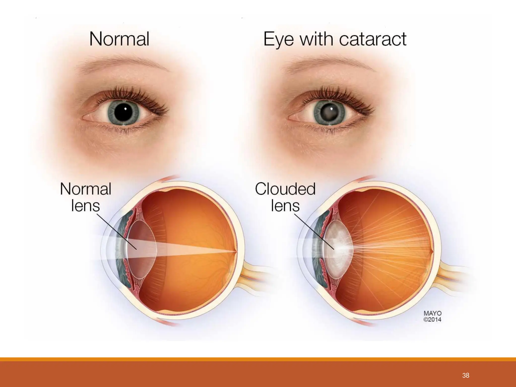 Adult Health Nursing unit eye and ear part 2.ppt