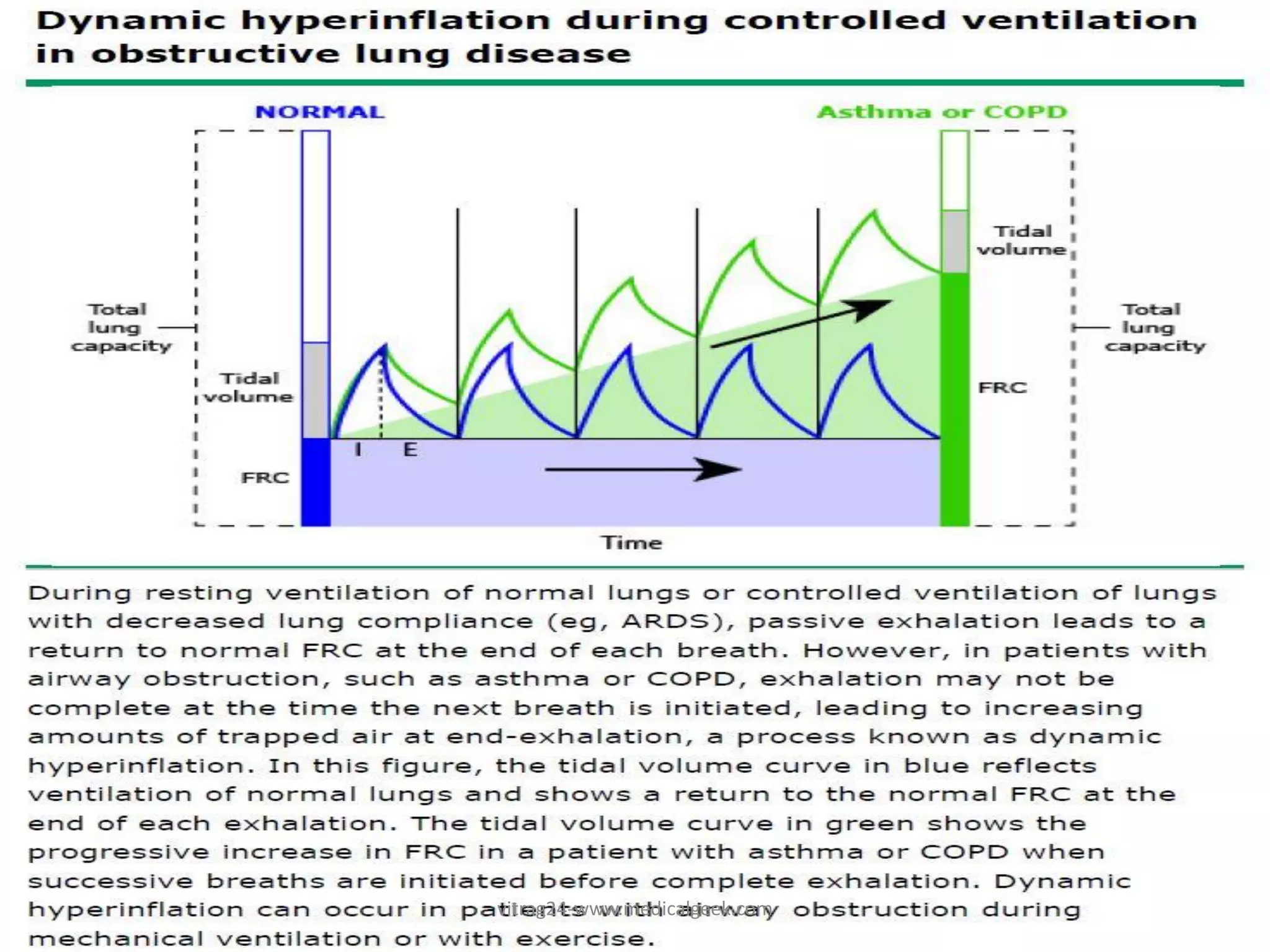 Ventilatory management of Acute Hypercapnic Respiratory Failure | PDF