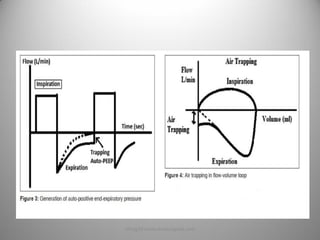 Ventilatory management of Acute Hypercapnic Respiratory Failure | PDF