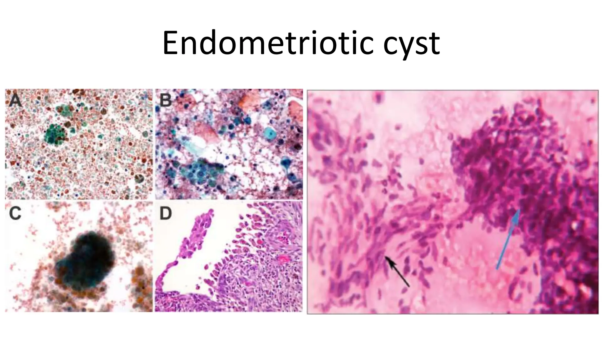 AHS-Ovarian tumor Cytology.pptx