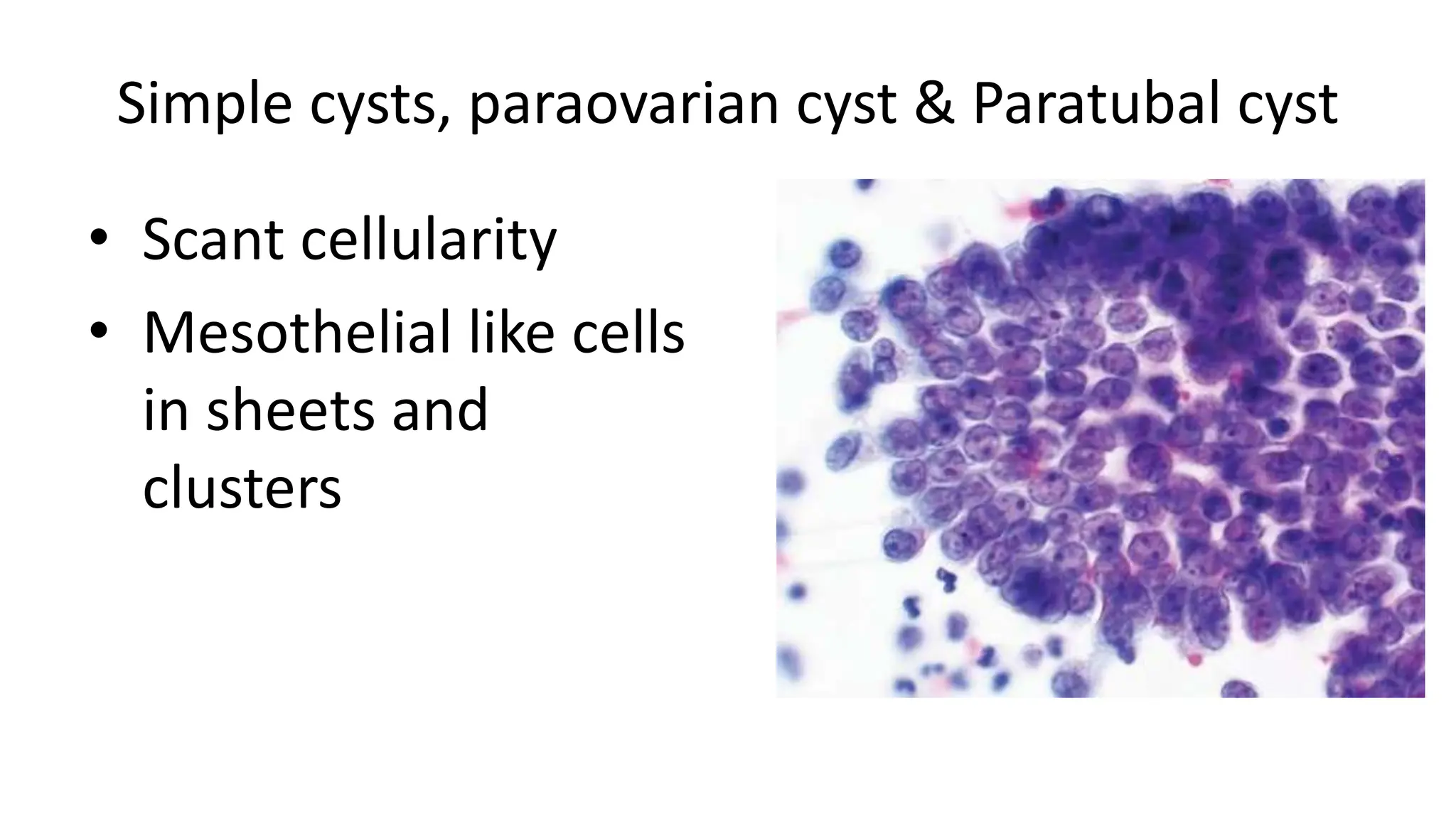 AHS-Ovarian tumor Cytology.pptx
