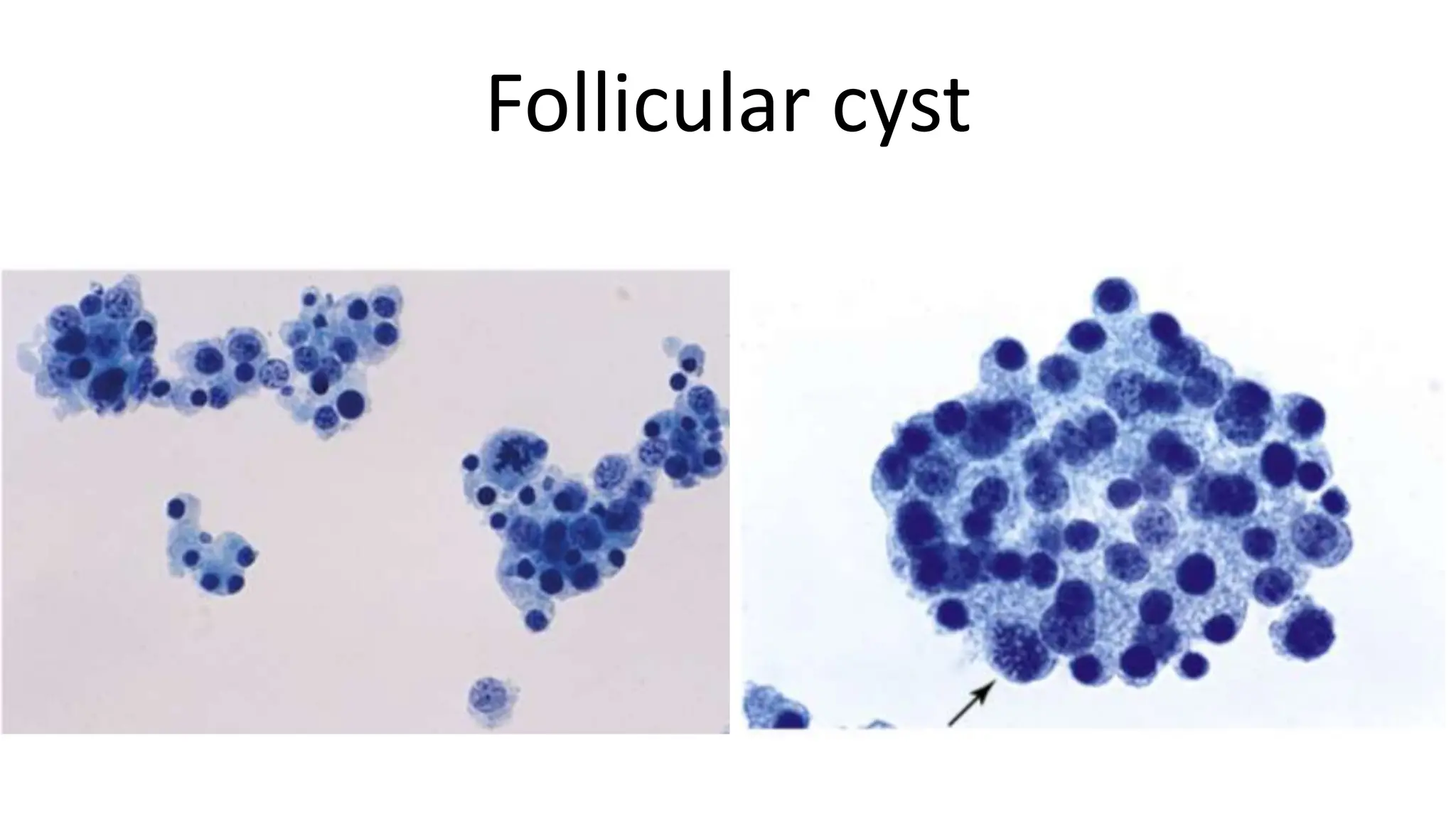 AHS-Ovarian tumor Cytology.pptx