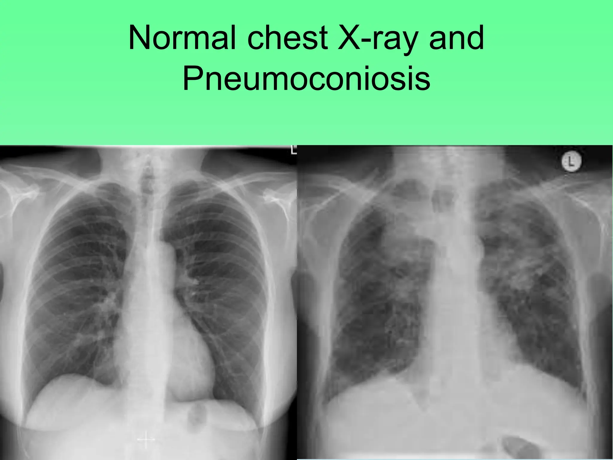 Pneumoconiosis, Lung disease, Dust disease | PPT