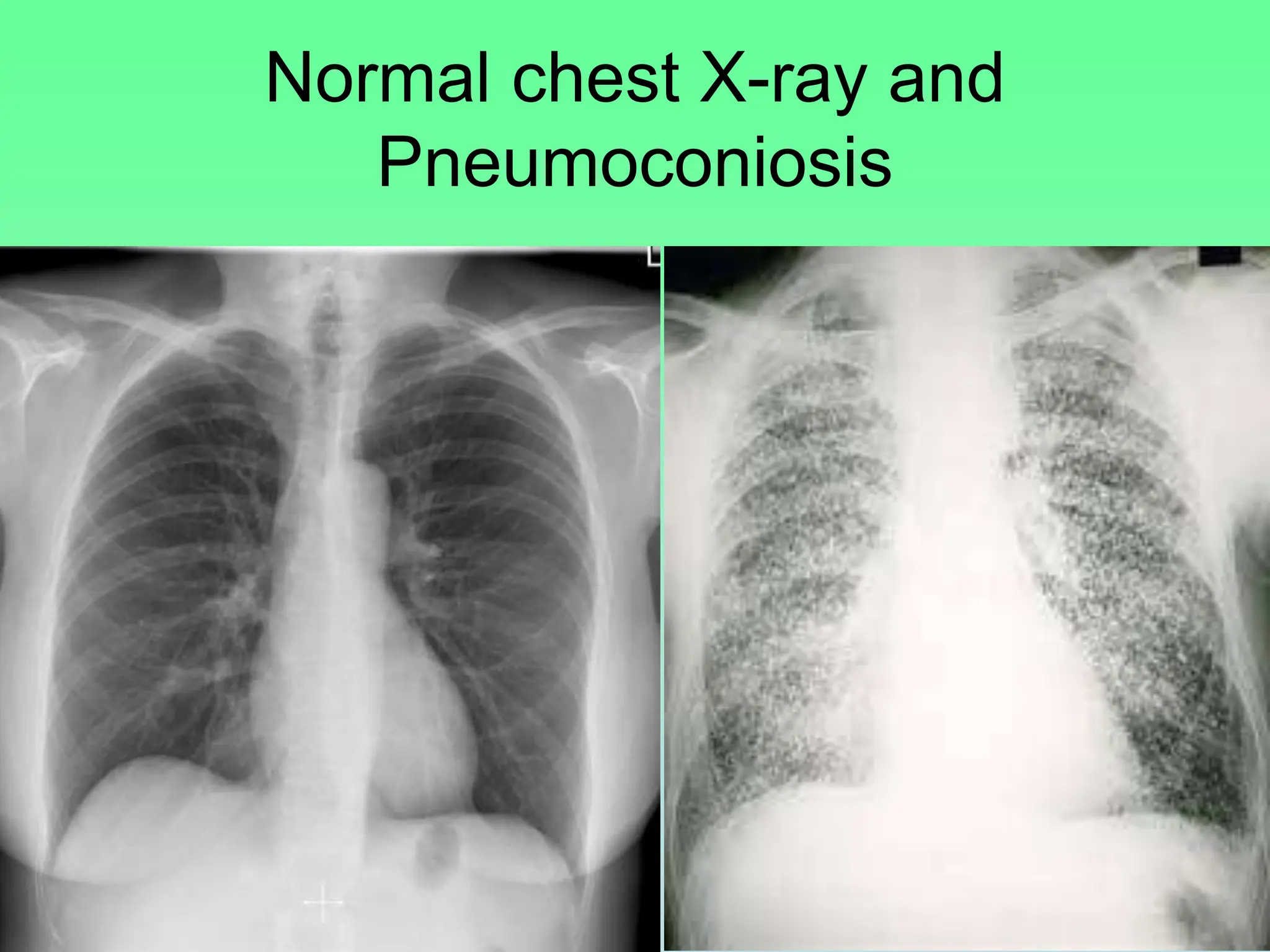 Pneumoconiosis, Lung disease, Dust disease | PPT
