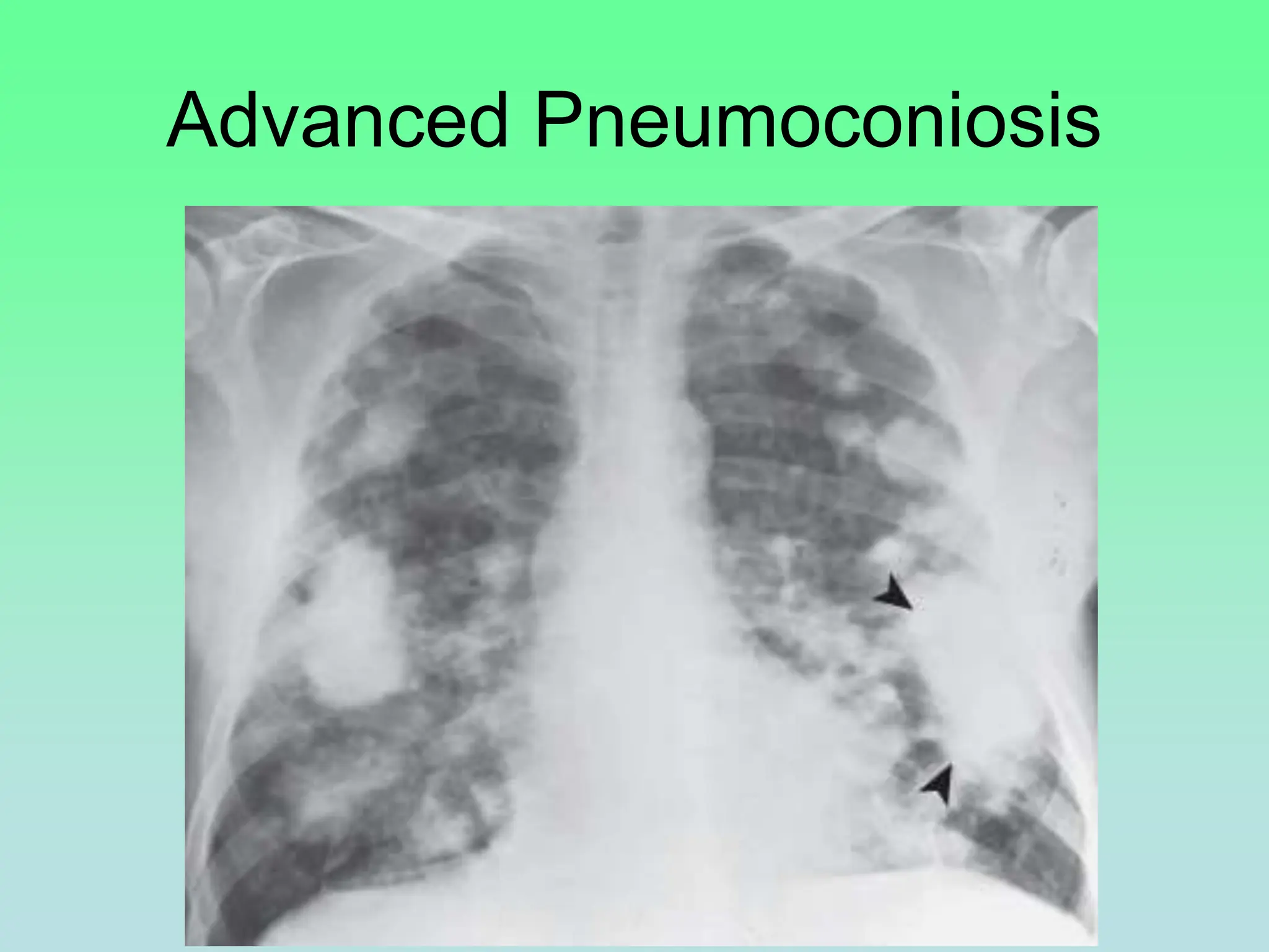 Pneumoconiosis, Lung disease, Dust disease | PPT