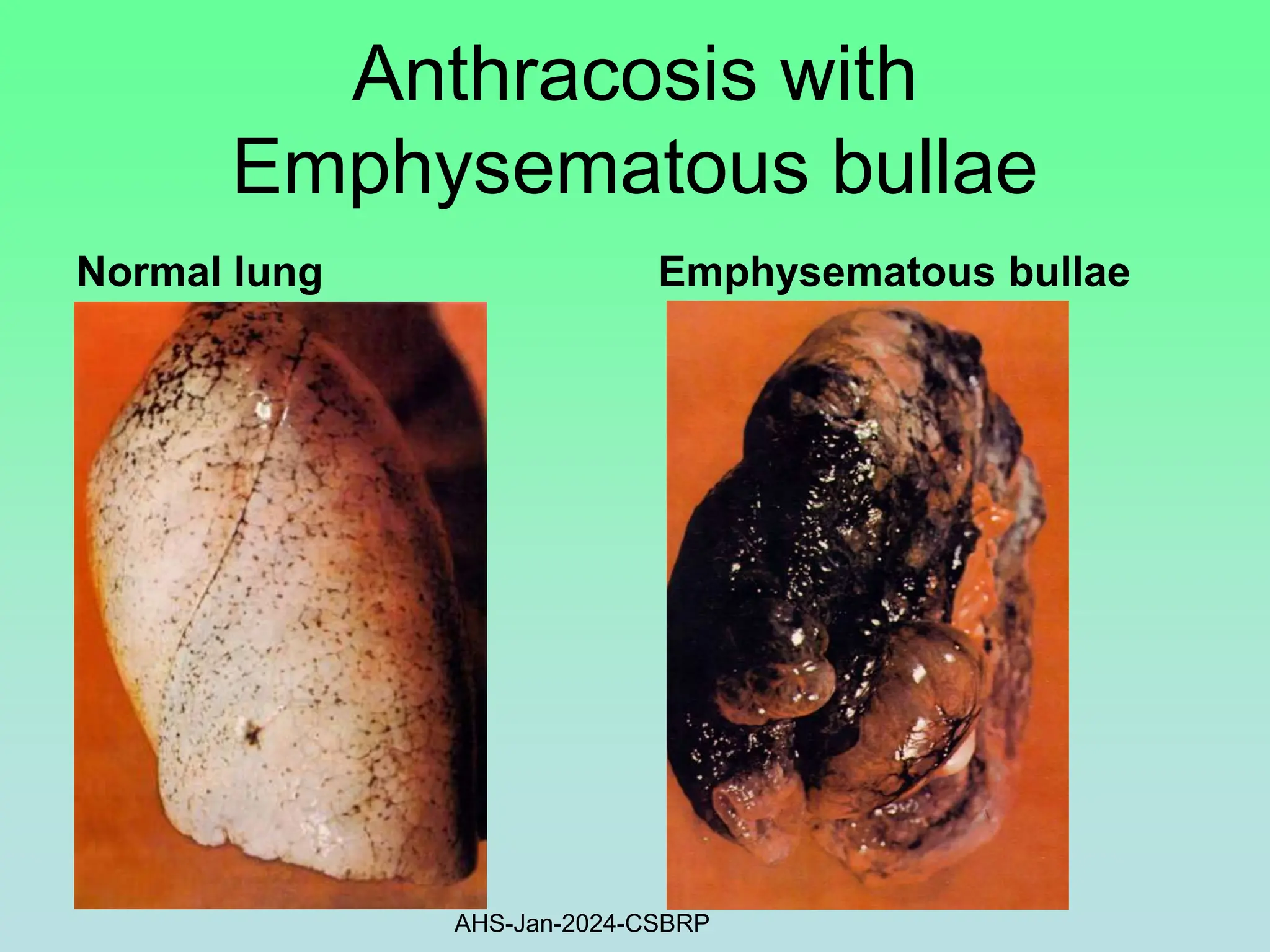 Pneumoconiosis, Lung disease, Dust disease | PPT