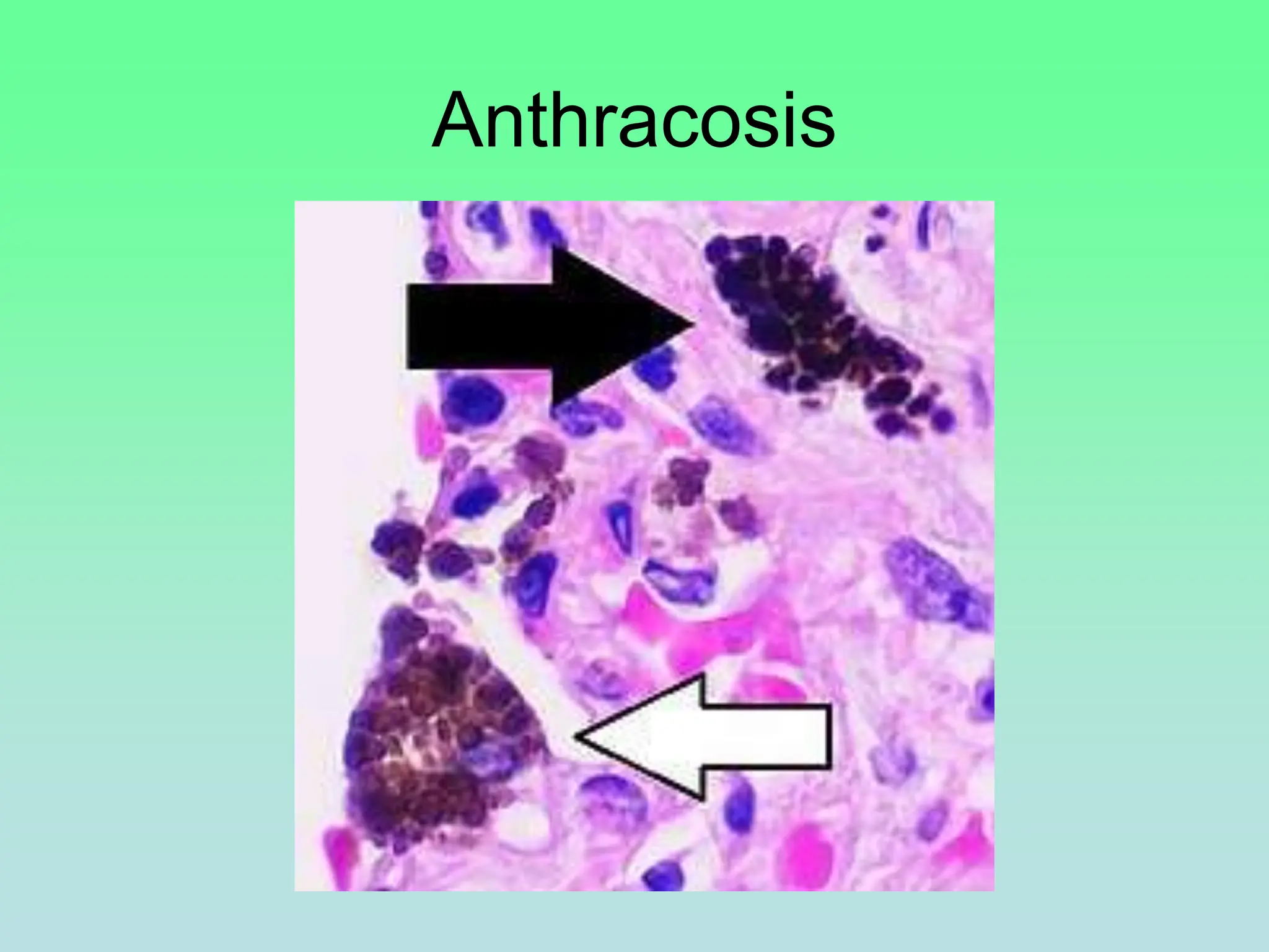 Pneumoconiosis, Lung disease, Dust disease | PPT