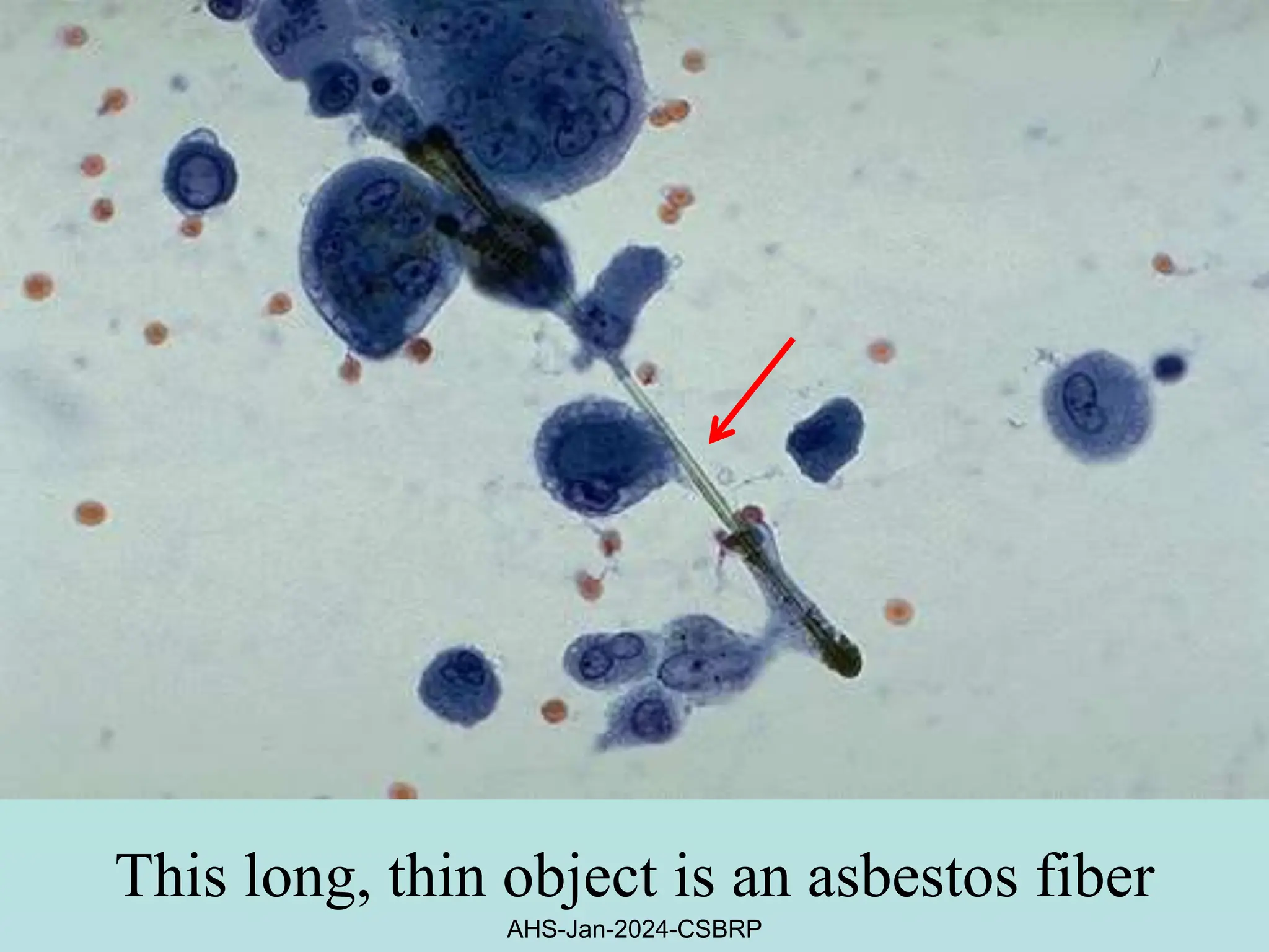 Pneumoconiosis, Lung disease, Dust disease | PPT