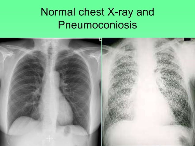 Pneumoconiosis, Lung disease, Dust disease | PPT