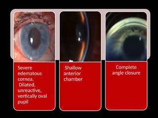 Angle closure glaucoma by MBBSstudent.pptx