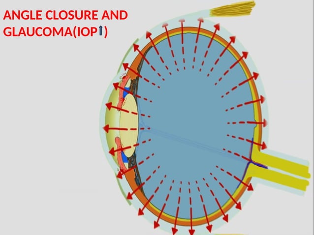 Angle closure glaucoma by MBBSstudent.pptx