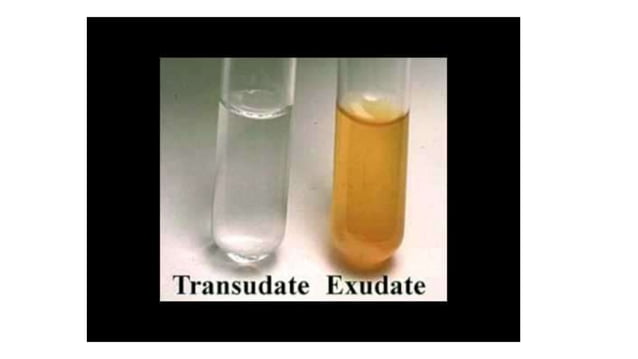 Edema, Transudate vs Exudate - Pathology - Allied courses | PPTX ...