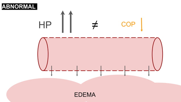 Edema, Transudate vs Exudate - Pathology - Allied courses | PPTX ...