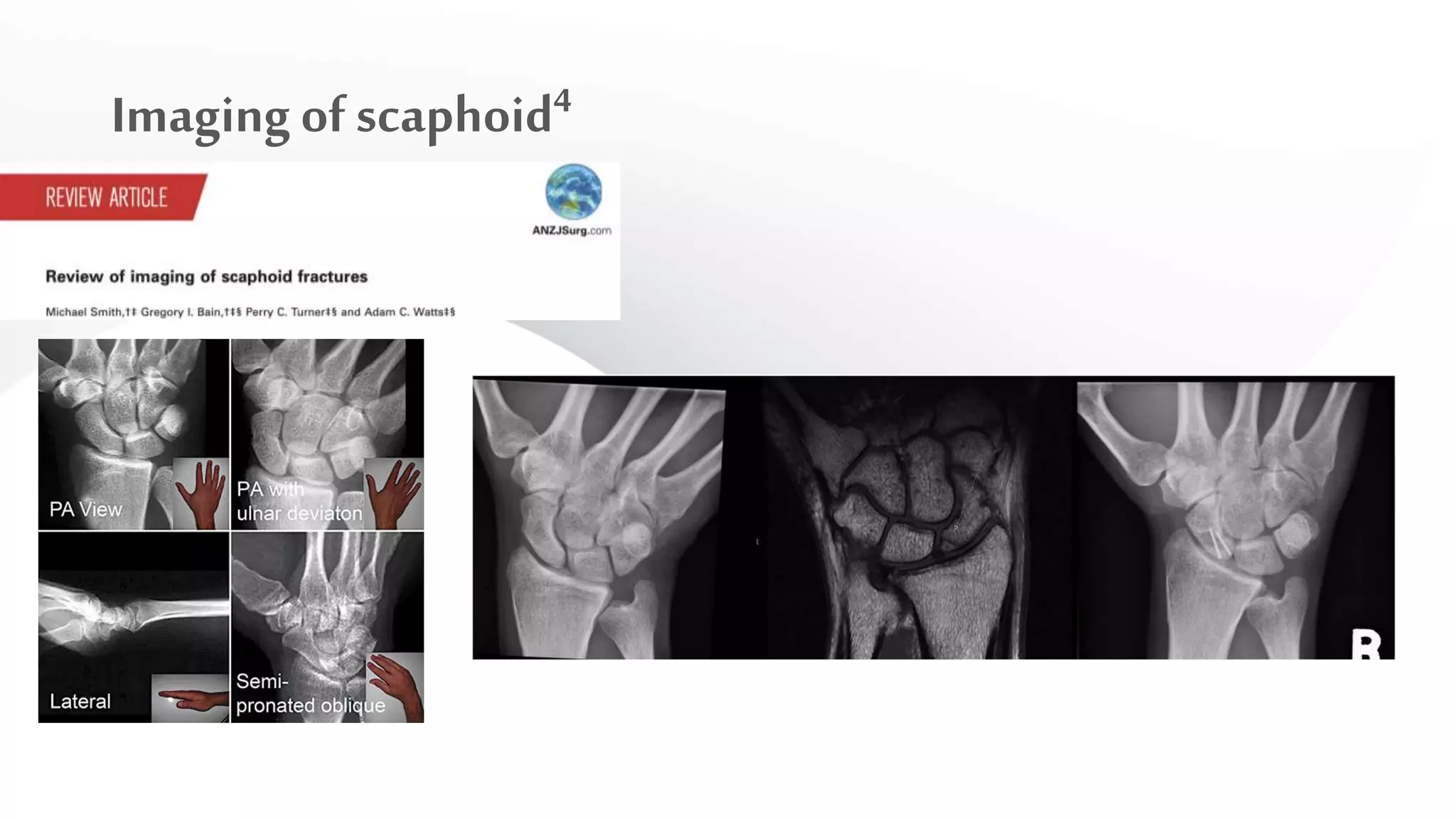 AHSS Registrar Review Course. Scaphoid and carpal fractures | PPTX