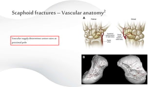 AHSS Registrar Review Course. Scaphoid and carpal fractures | PPTX