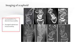 AHSS Registrar Review Course. Scaphoid and carpal fractures | PPTX
