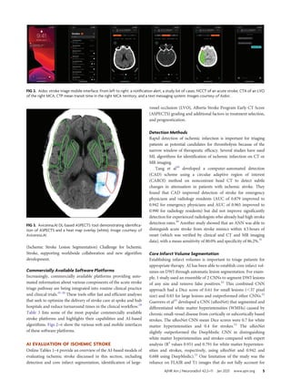Ai and acute stroke imaging | PDF