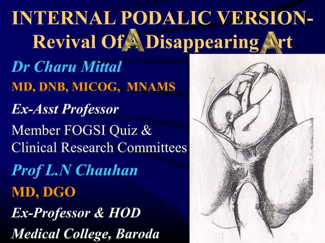 "Internal podalic version- revival of a disappearing art" | PPT