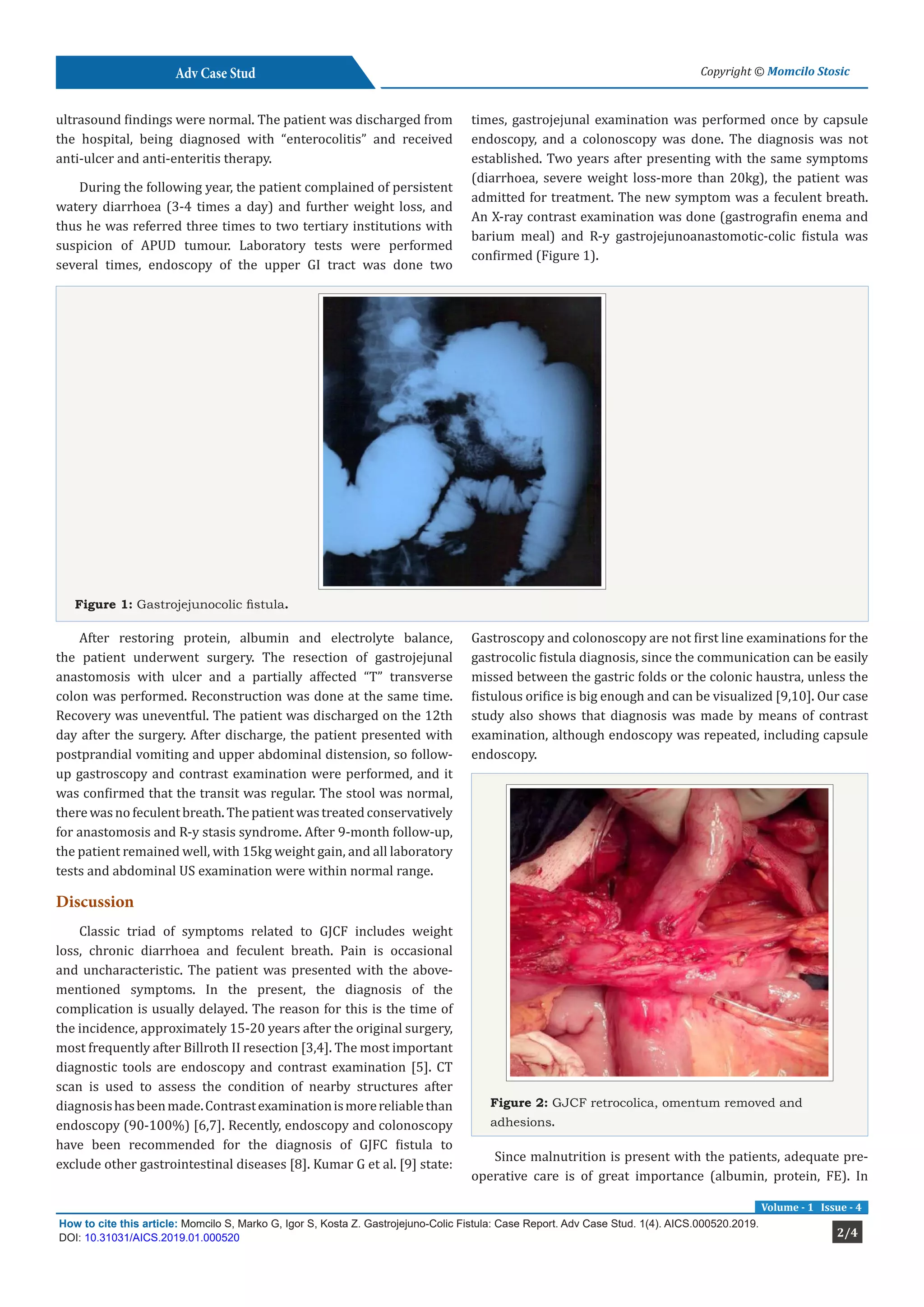Gastrojejuno-Colic Fistula: Case Report_Crimson Publishers | PDF