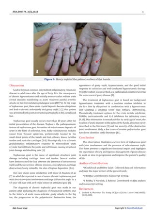 Severe Tophaceous Gout_Crimson Publishers | PDF