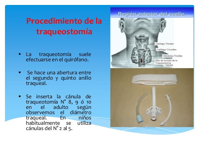 traqueostomía