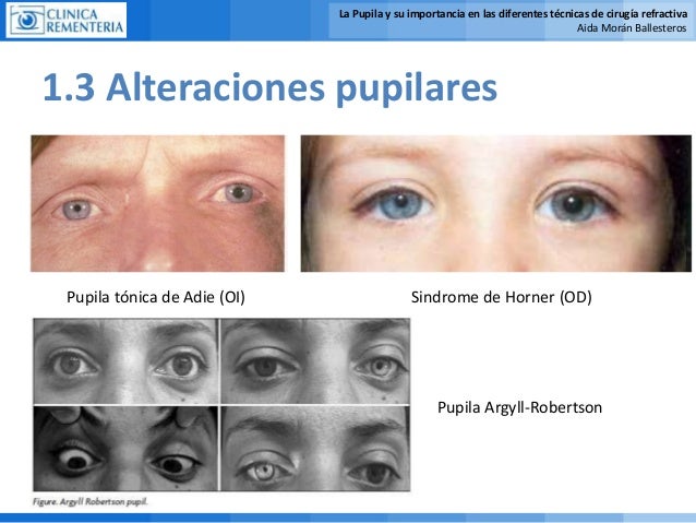 Pathophysiology of argyll robertson pupil - architectskool