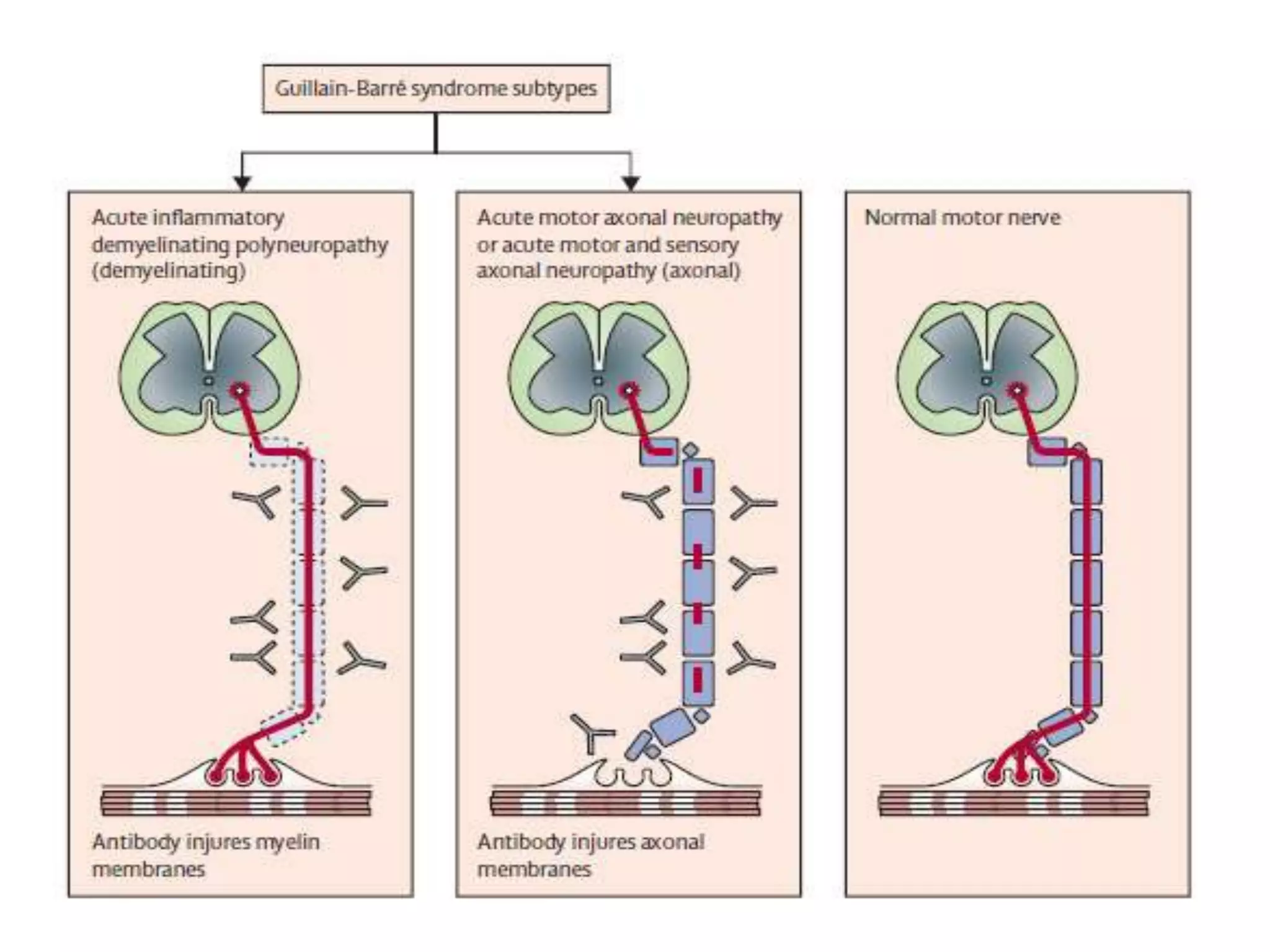 acute inflammatory demyelinating polyneuropathy | PPTX