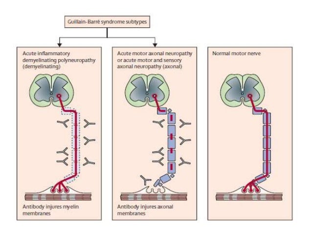acute inflammatory demyelinating polyneuropathy
