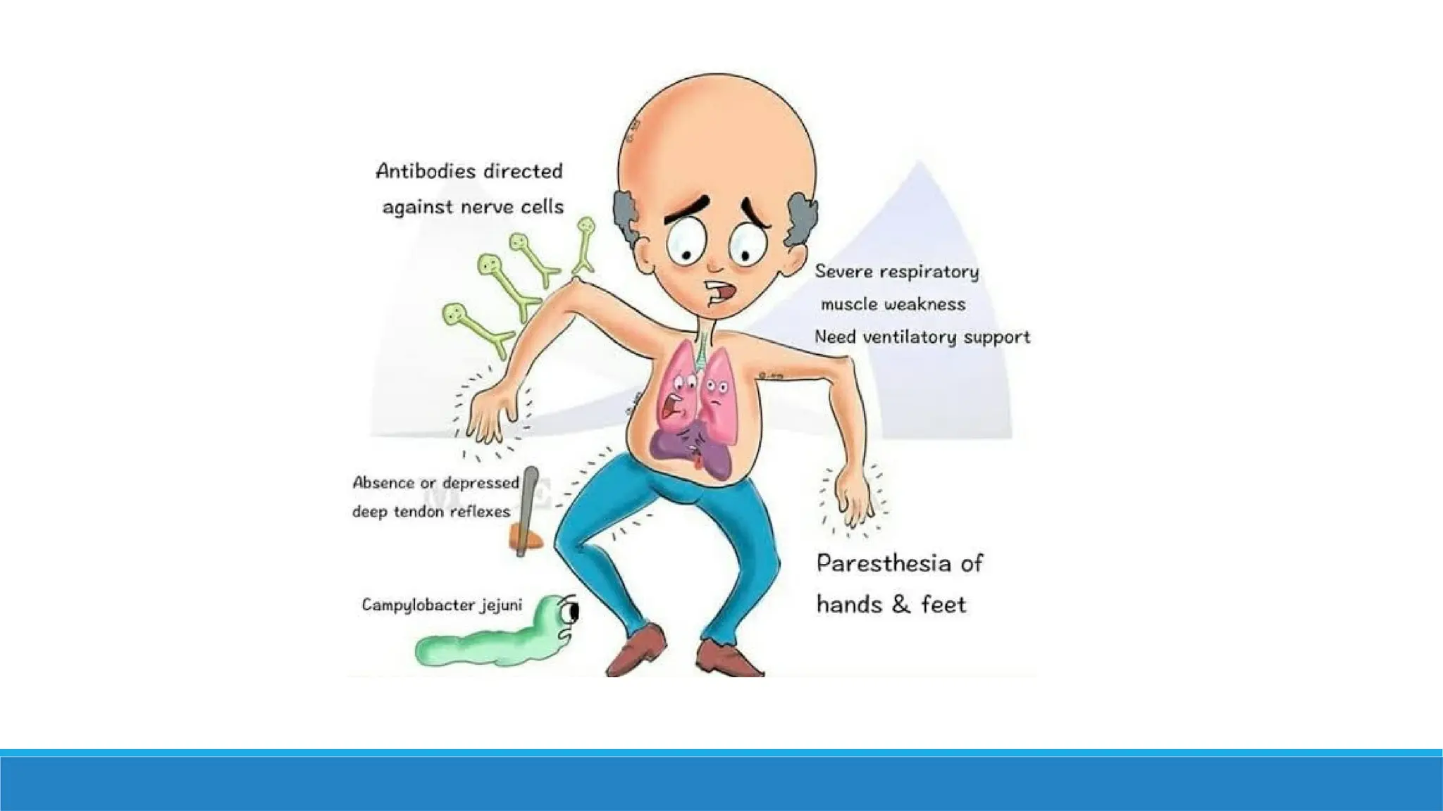 AIDP (acute inflammatory demyelinating paraplegia | PPT