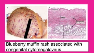 AIDS- Opportunistic infections | PPTX