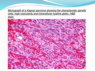 Aids defining neoplasm | PPT