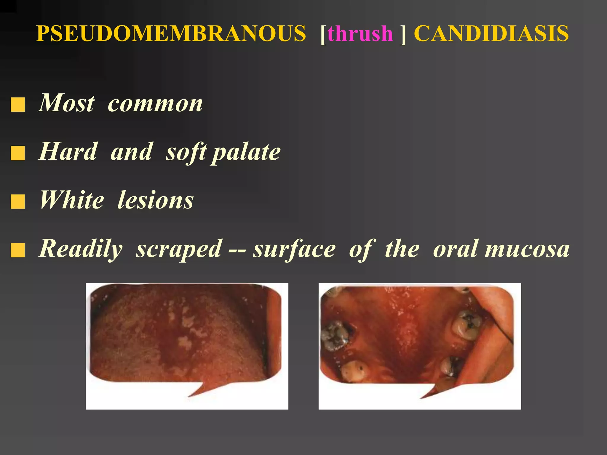 AIDS AND PERIODONTIUM.ppt