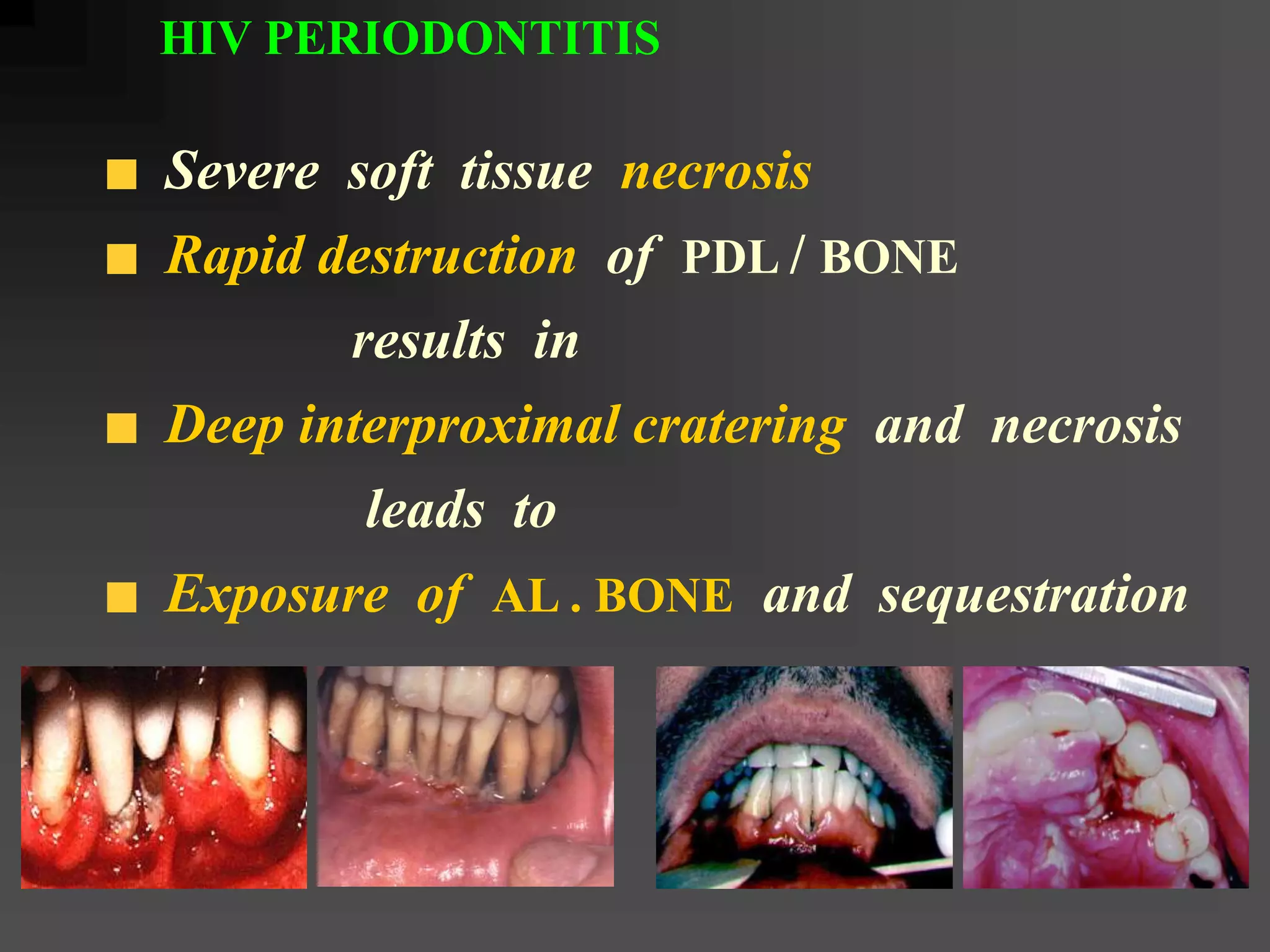 AIDS AND PERIODONTIUM.ppt