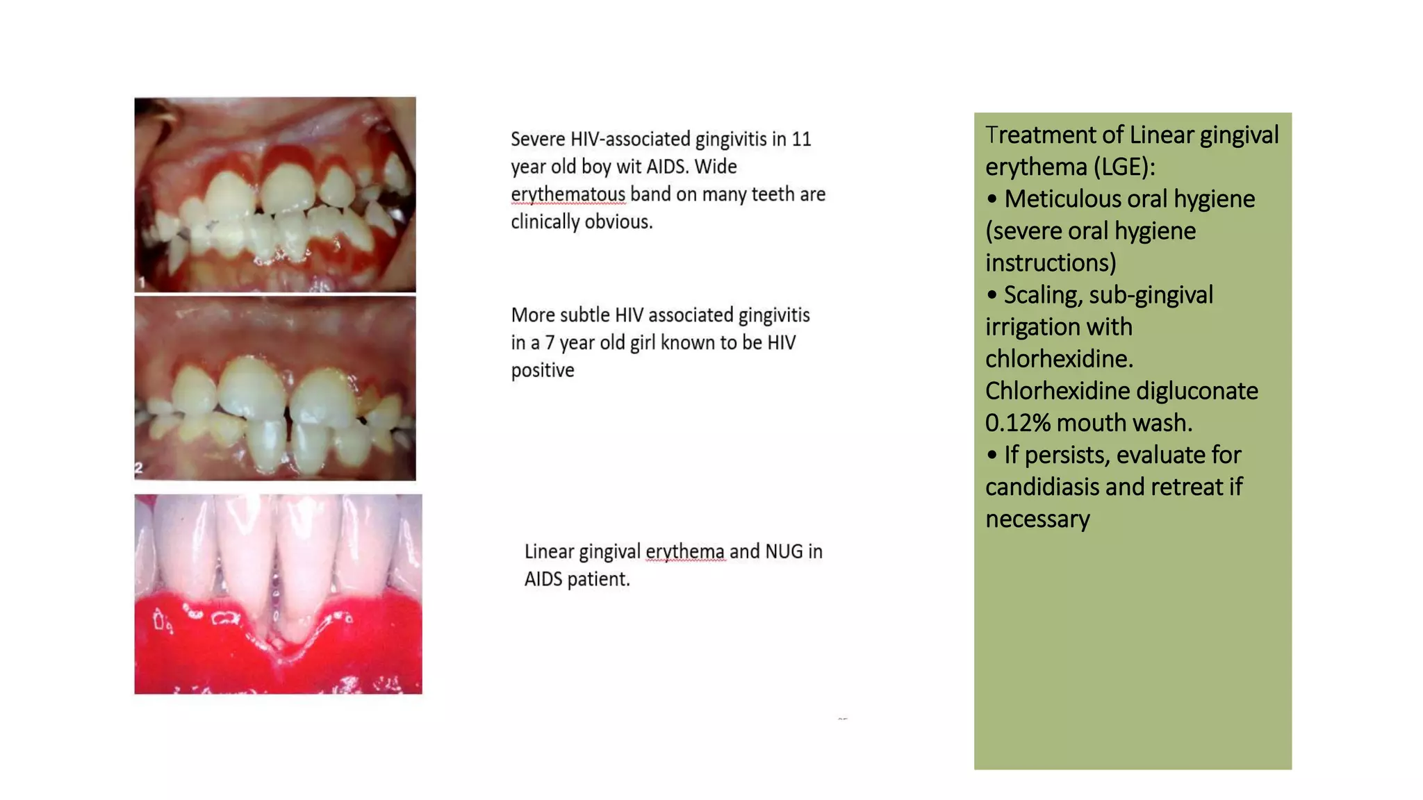 AIDS AND PERIODONTIUM.pptx