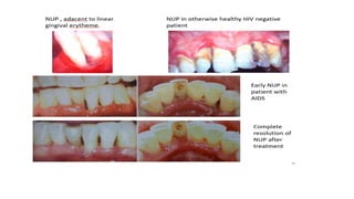 AIDS AND PERIODONTIUM.pptx