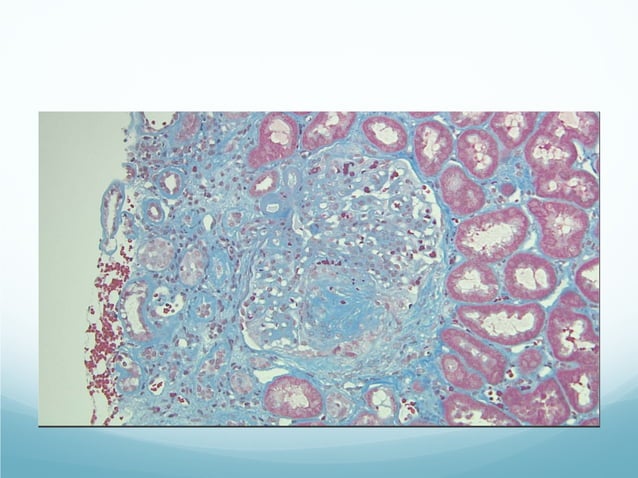 Renal Disease In Hivaids Ppt