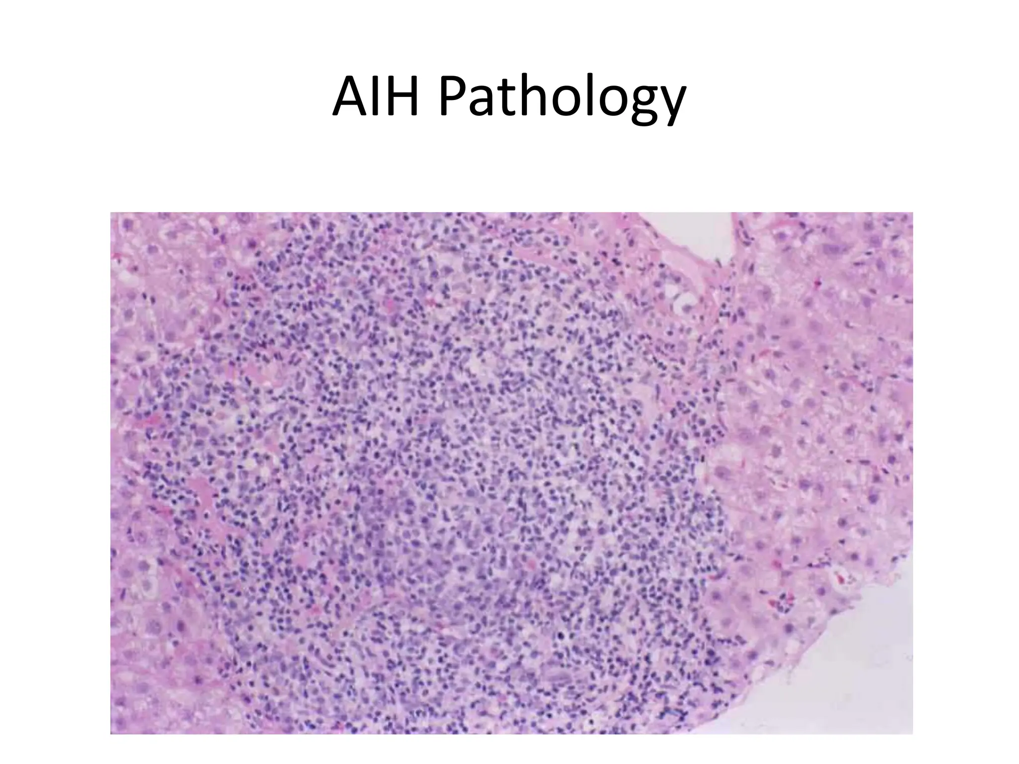 Autoimmune Hepatitis-update-2021 powerpoint | PPT