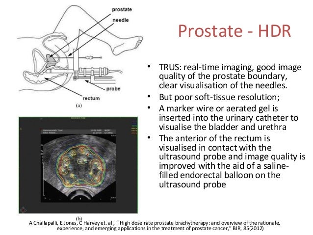 Advances in Brachytherapy Treatment Planning and Delivery