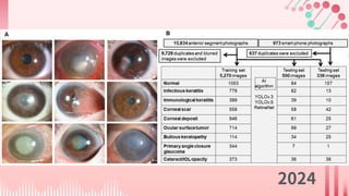 人工智慧於眼科白內障手術的應用 (AI in Cataract Surgery) | PDF