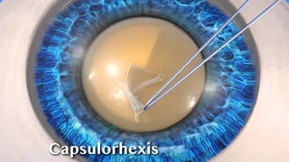 人工智慧於眼科白內障手術的應用 (AI in Cataract Surgery) | PDF