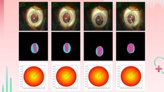 人工智慧於眼科白內障手術的應用 (AI in Cataract Surgery) | PDF