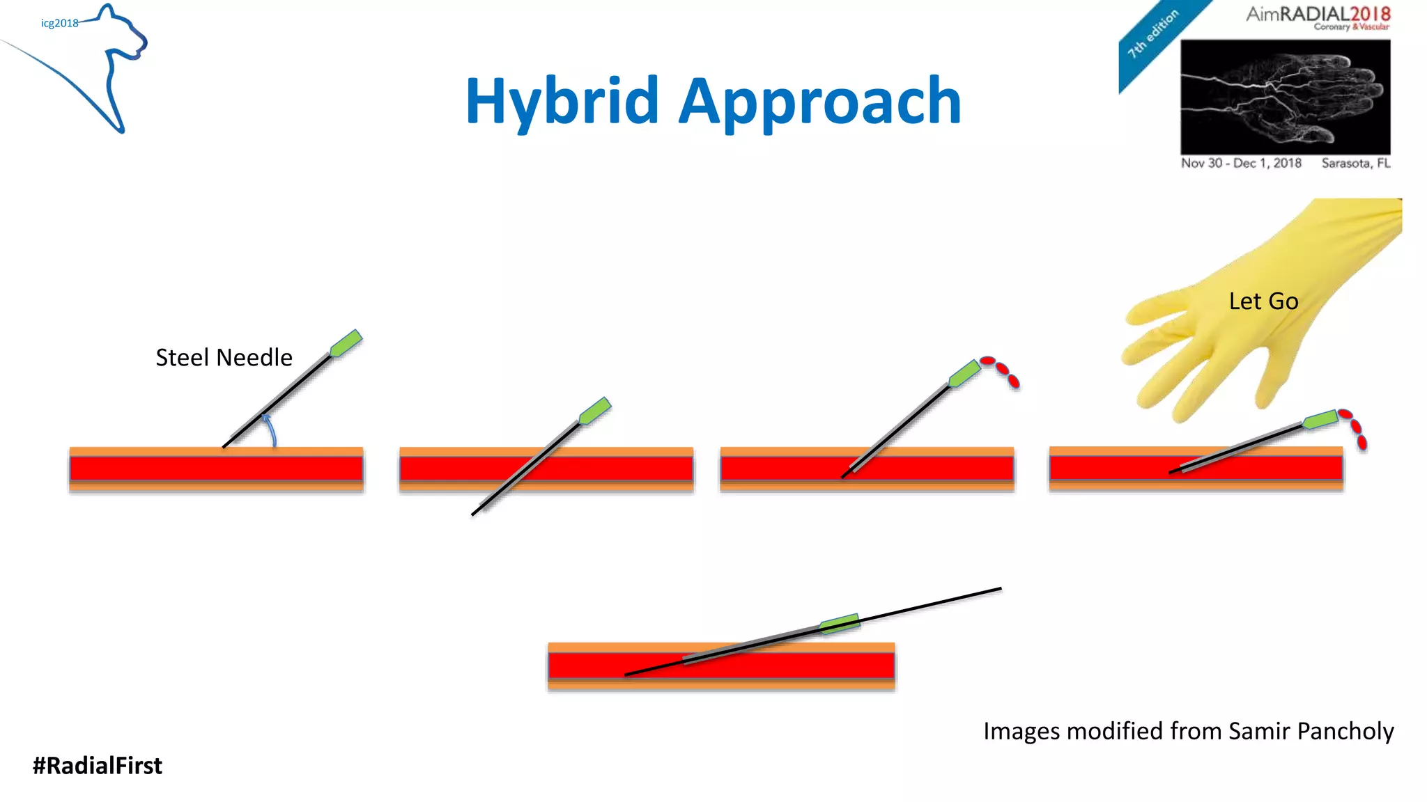 PCI & AimRadial 2018 | Radial Artery Puncture - Ian C Gilchrist | PPTX